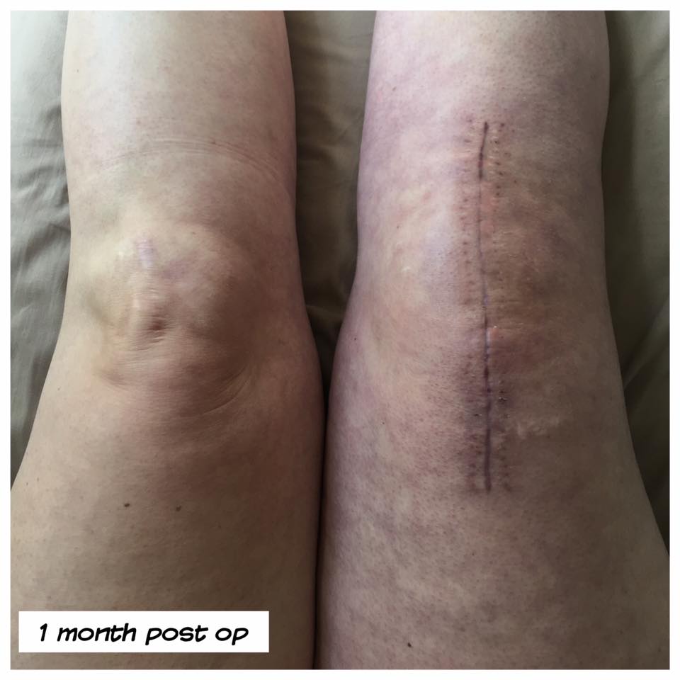 Scar progress – Knee Replacement Resource