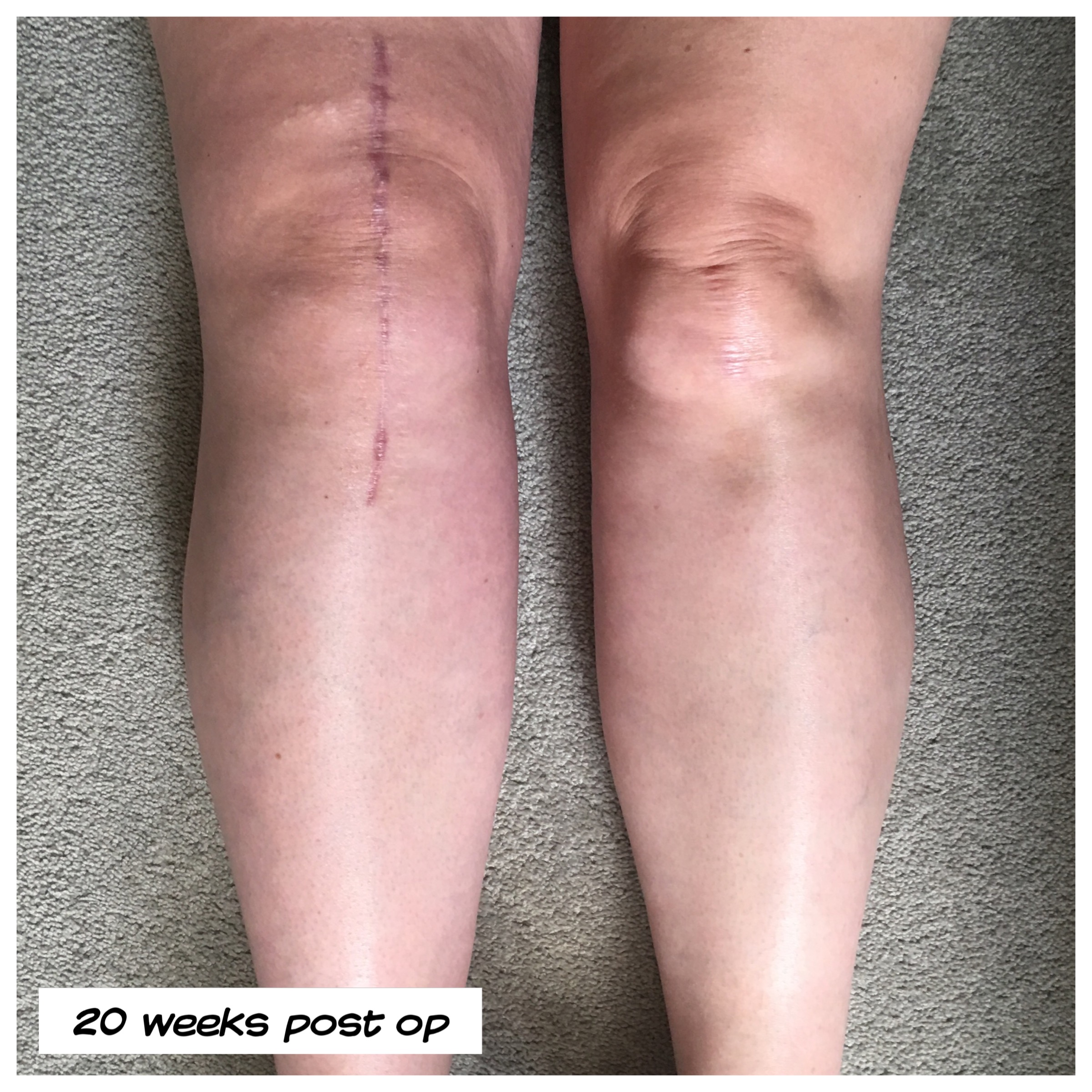 Scar progress – Knee Replacement Resource