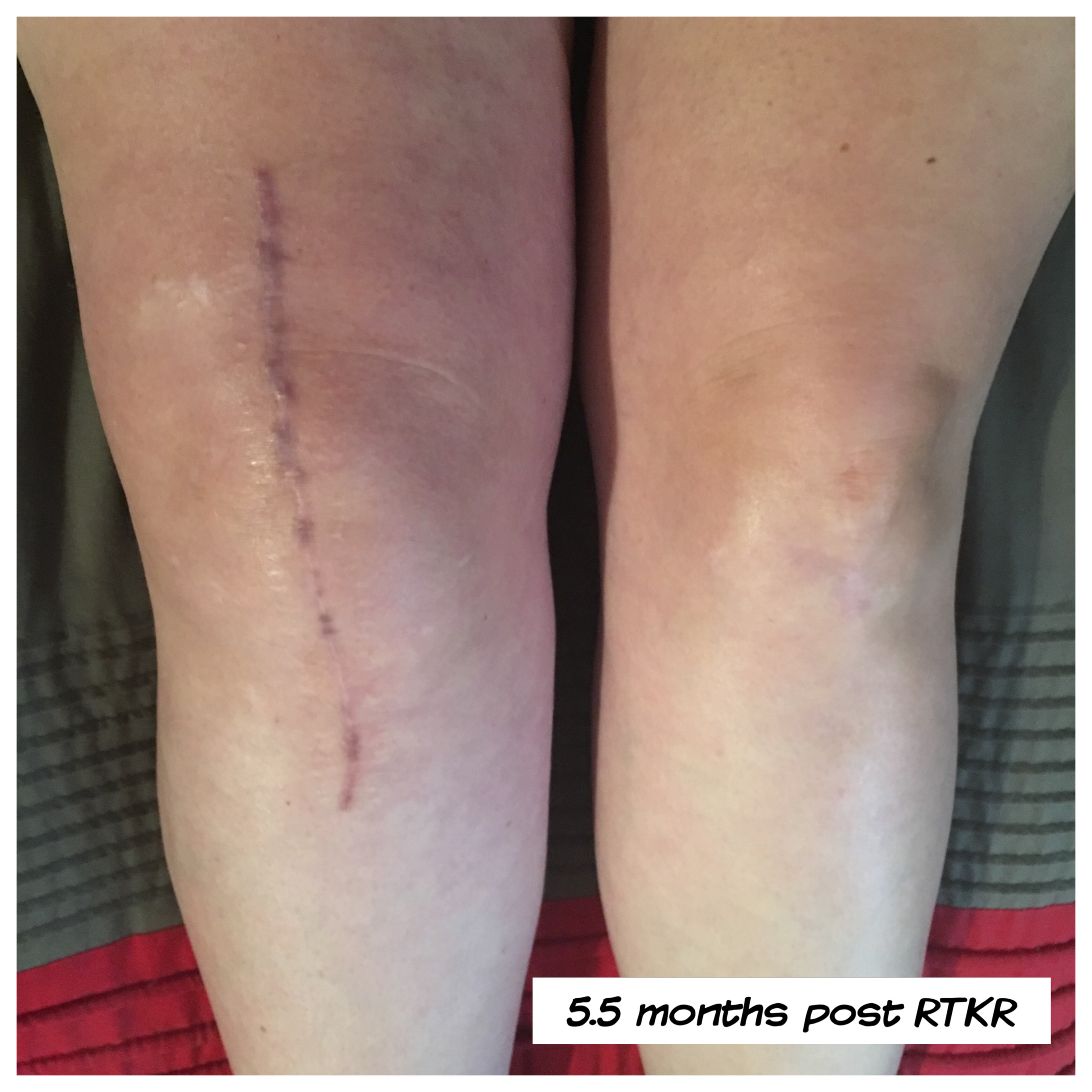 Scar progress – Knee Replacement Resource